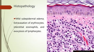 Papular urticaria | PPTX