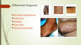 Papular urticaria | PPTX