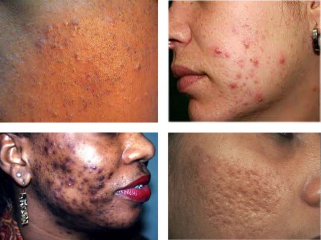 differentials of papules on face | PPTX | Skin and Dermatology ...