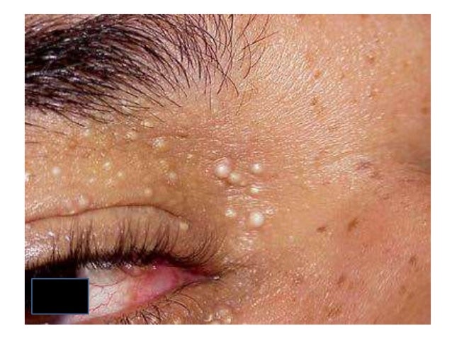 differentials of papules on face