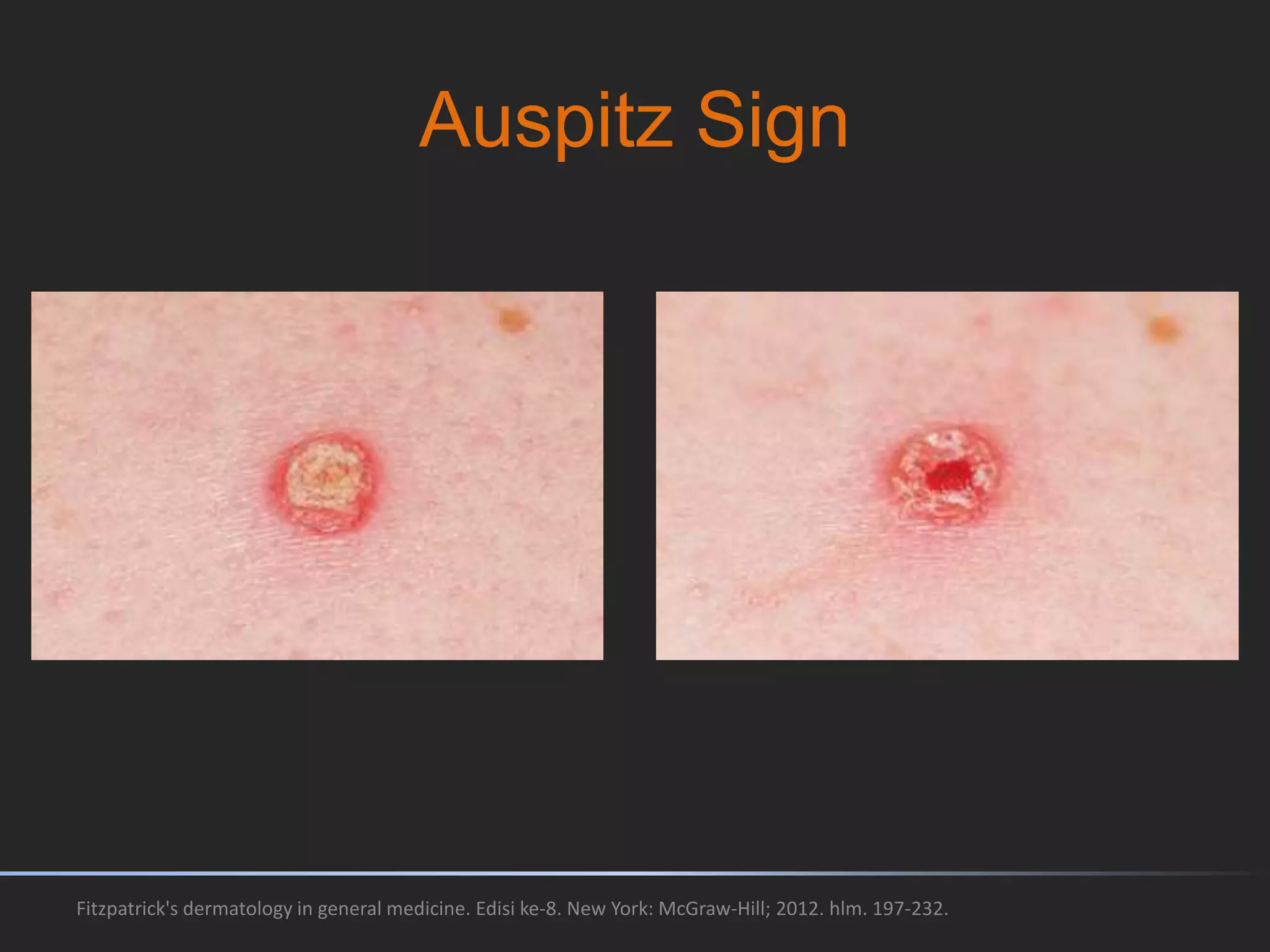 Papulosquamous disorders | PPTX