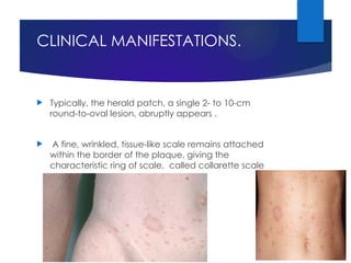 Papulosquamous Disorders including psoriasis, lichen planus, pityriasis ...