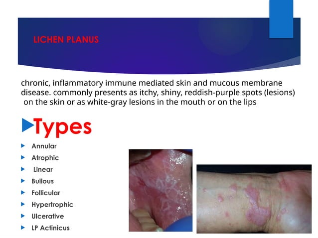 Papulosquamous Disorders including psoriasis, lichen planus, pityriasis rosea.pptx