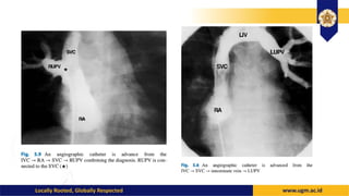 papvd partial anomalous pulmonary vein drainage.pptx