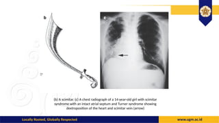 papvd partial anomalous pulmonary vein drainage.pptx