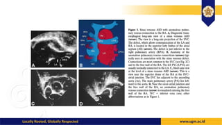 papvd partial anomalous pulmonary vein drainage.pptx
