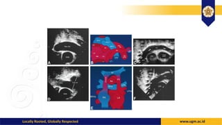 papvd partial anomalous pulmonary vein drainage.pptx