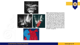 papvd partial anomalous pulmonary vein drainage.pptx | Free Download