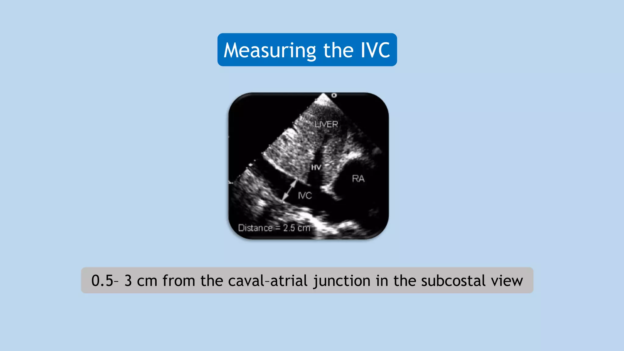 Non-invasive haemodynamic monitoring by Echocardiography | PPTX