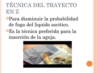 Paracentesis | PPT