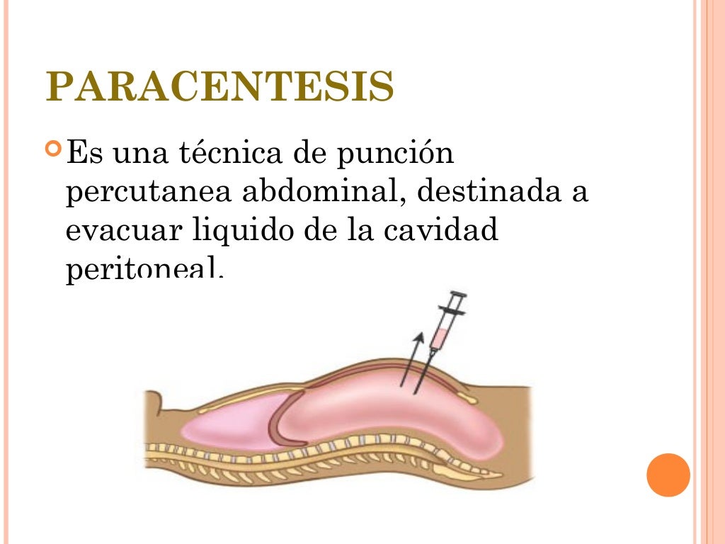 Paracentesis