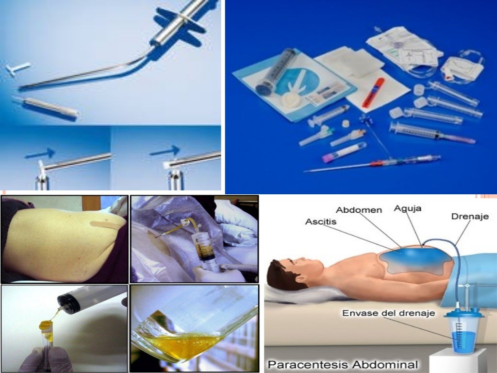 O Que é Paracentese - BRAINCP