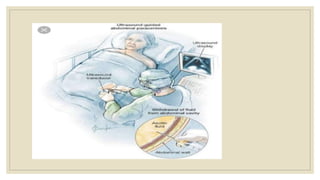 Paracentesis | PPTX