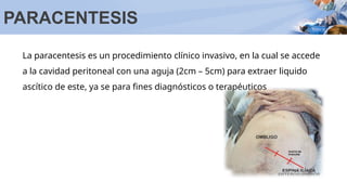 PARACENTESIS.pptxnnfnnggjtrhtjyhrrfgwhgewfheewgmrqr | PPTX