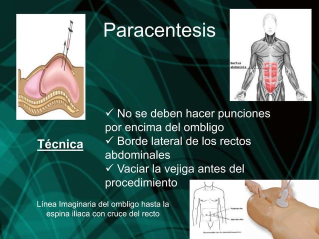 Paracentesis y lavado peritoneal2