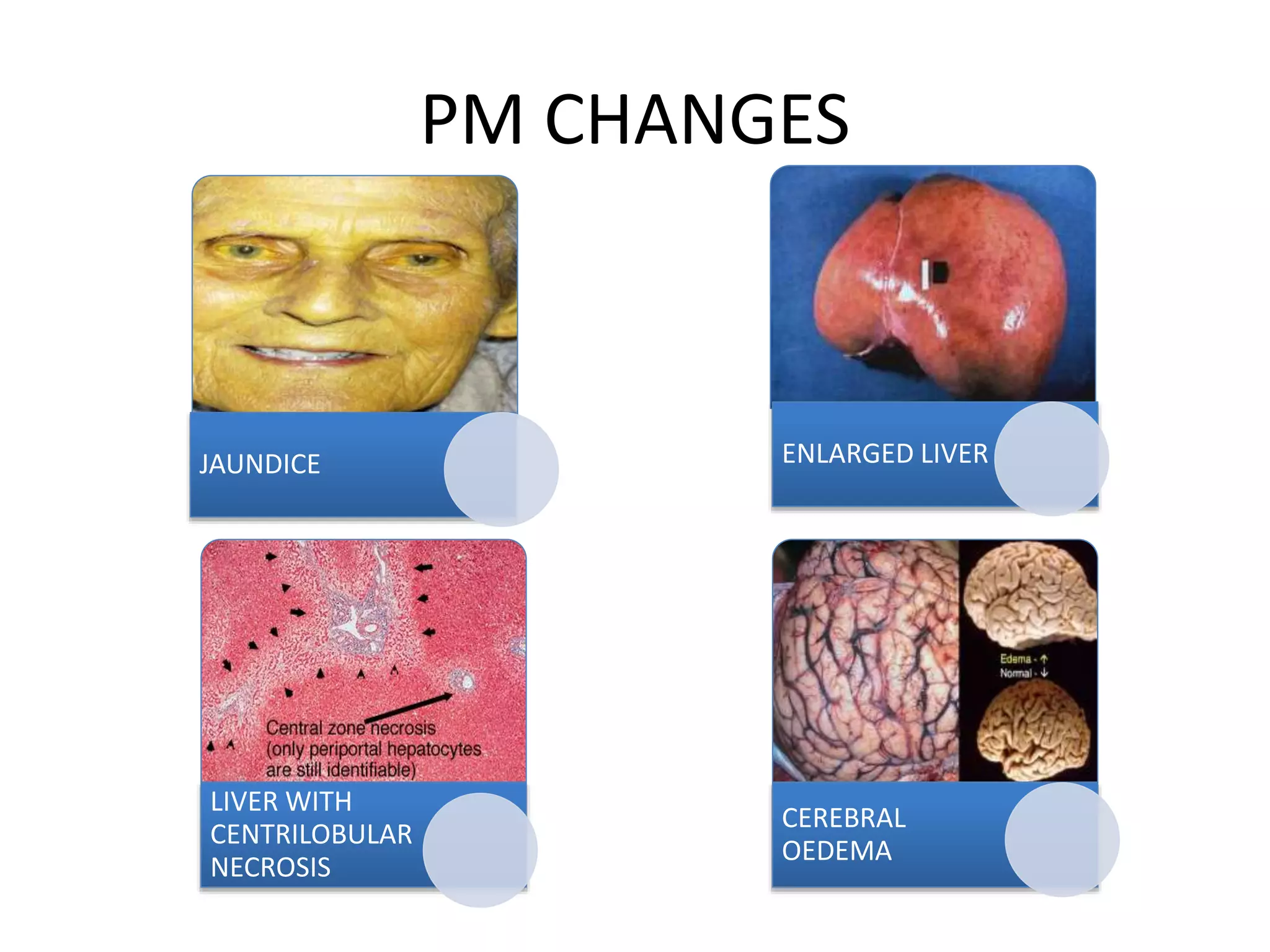 Paracetamol poisoning | PPTX