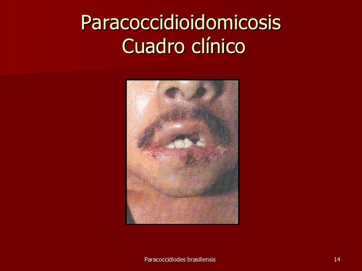 Paracoccidioidomicosis 1 [1]