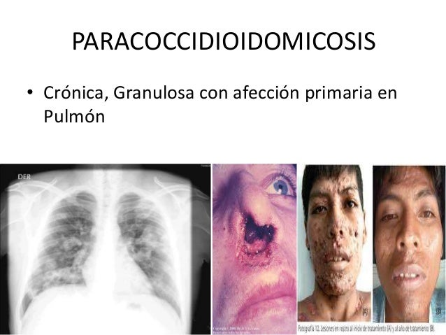 Paracoccidioidomicosis