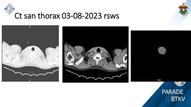 Parade BTKV - Tumor Sternum.pptx