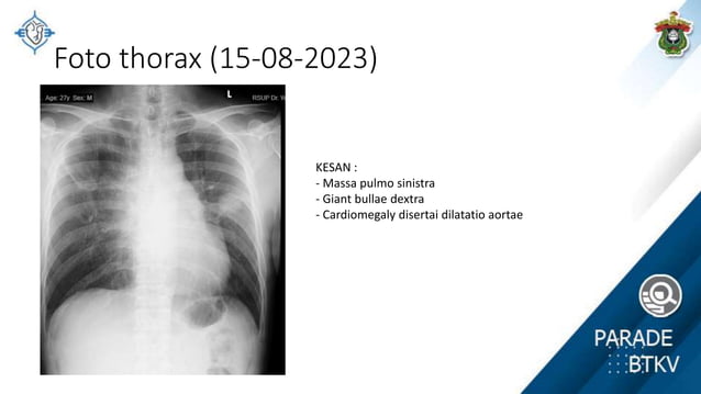 Parade BTKV - Tumor Sternum.pptx