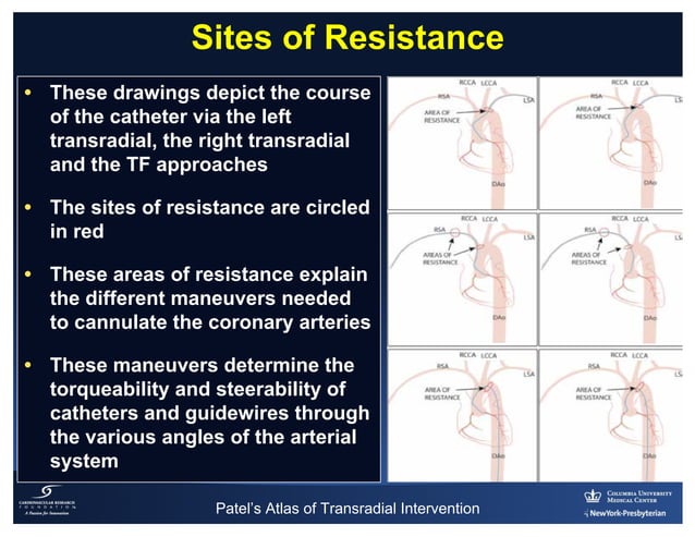Paradis JM - Transradial coronary angiography | PPT