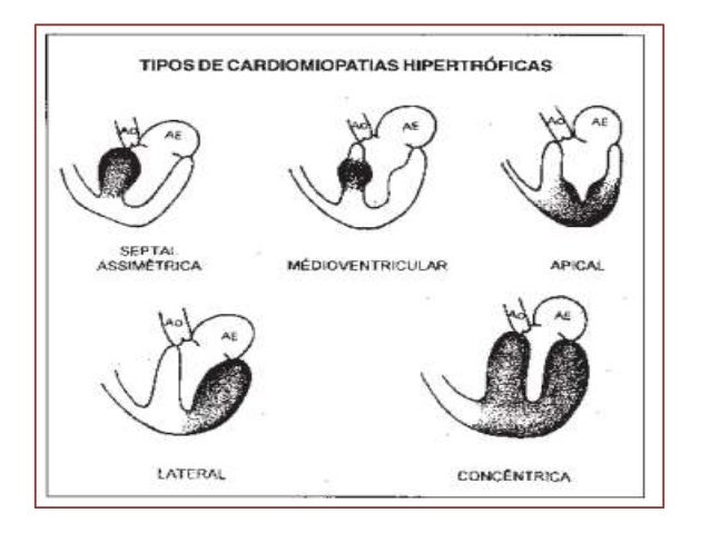 MIOCARDIOPATIA HIPERTROFICA (MCH).