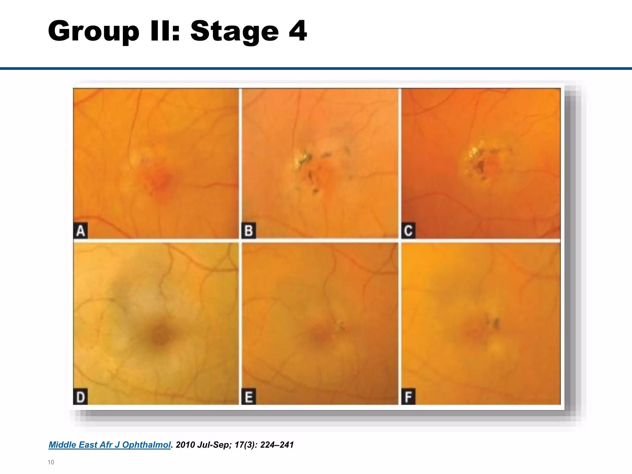 Parafoveal telangiectasia-- AJAY DUDANI | PPTX
