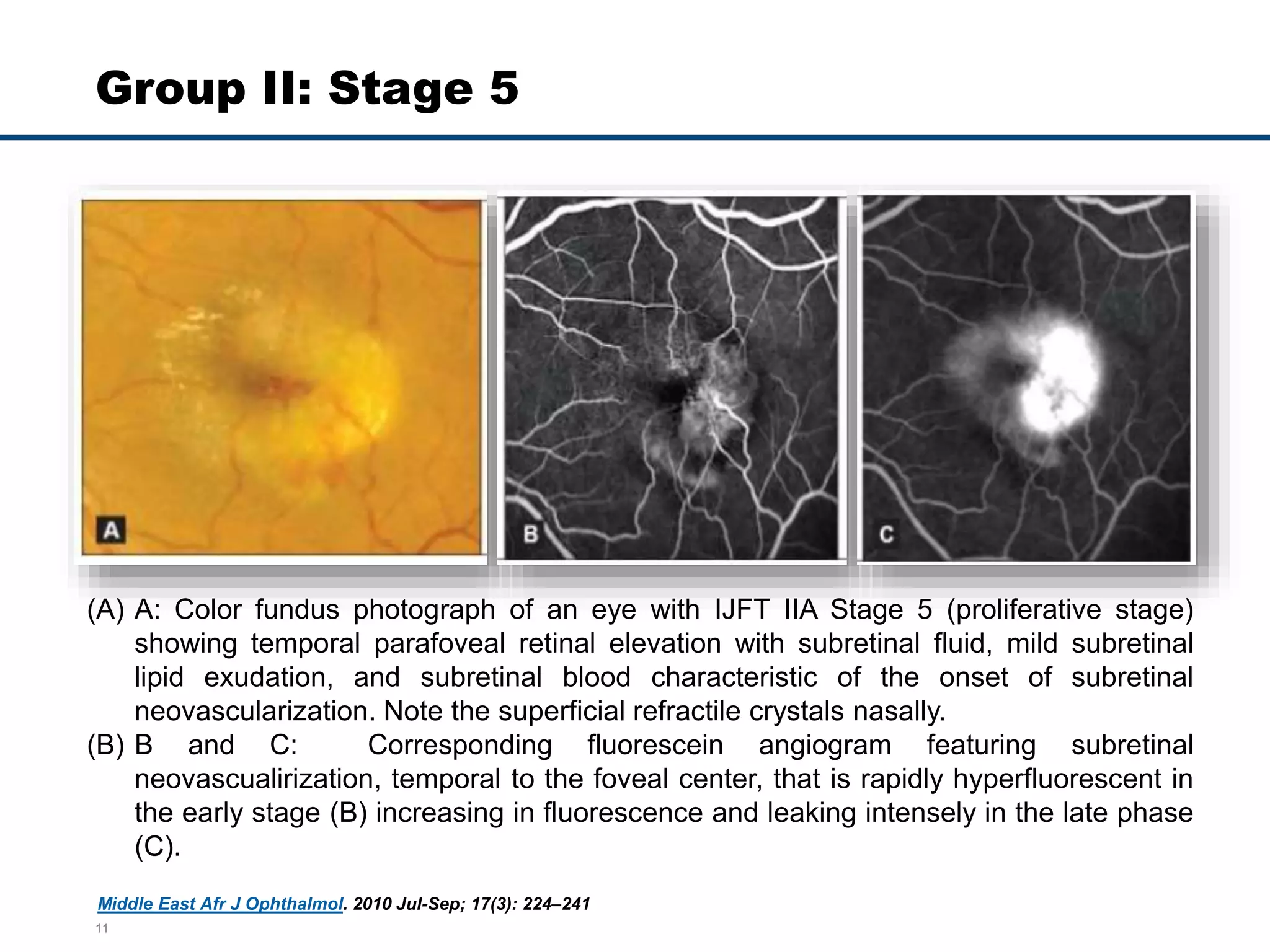 Parafoveal telangiectasia-- AJAY DUDANI | PPTX