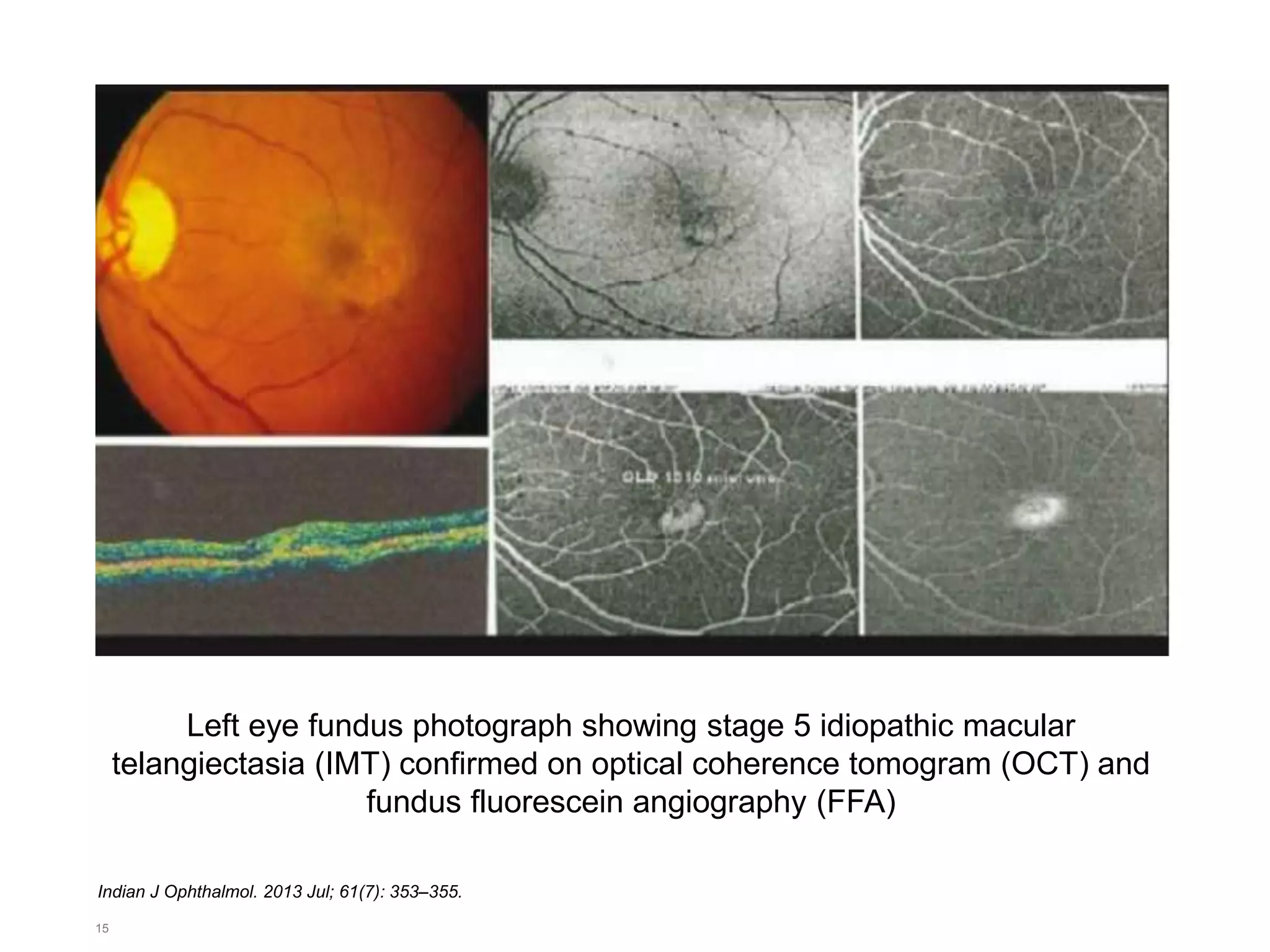 Parafoveal telangiectasia-- AJAY DUDANI | PPTX