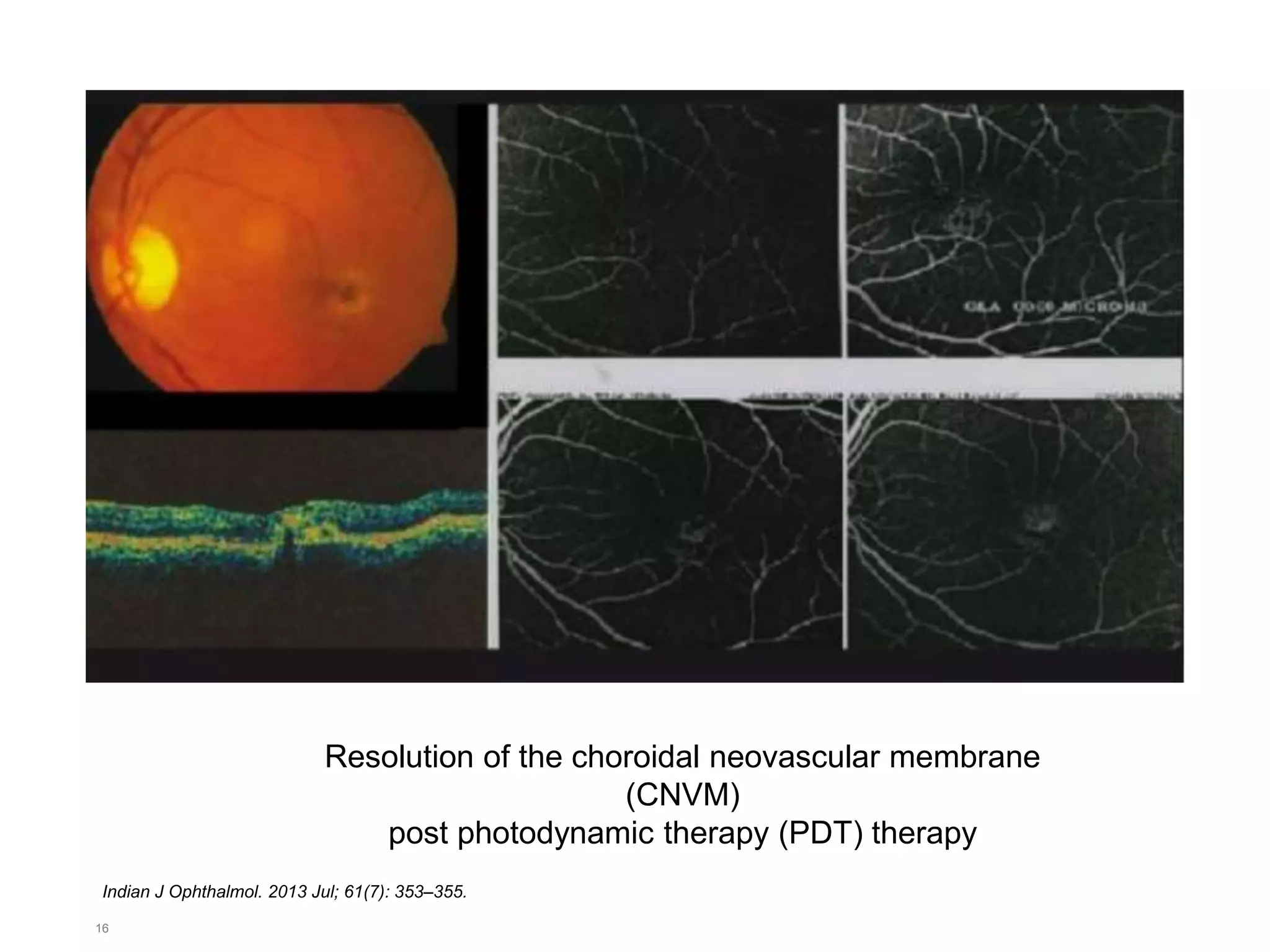 Parafoveal telangiectasia-- AJAY DUDANI | PPTX