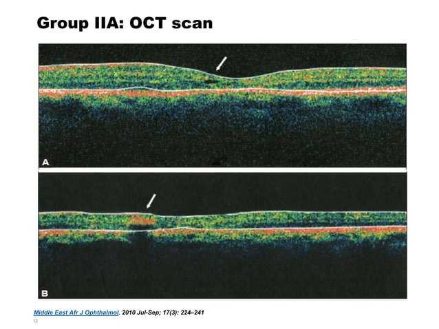 Parafoveal telangiectasia-- AJAY DUDANI | PPTX