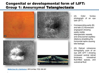 Parafoveal telangiectasia-- AJAY DUDANI | PPTX