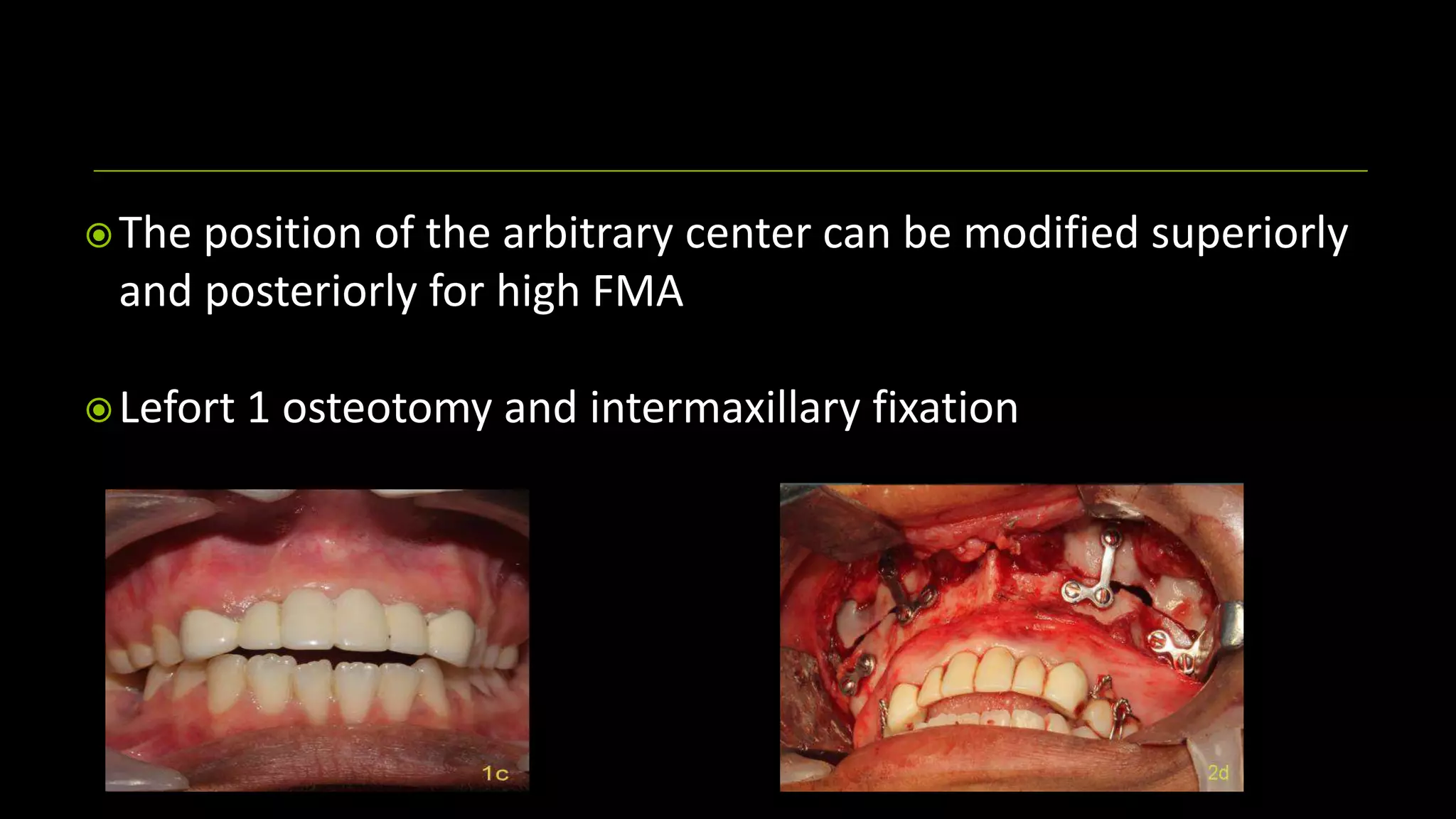 Parafunctional habits in prosthodontics | PPTX
