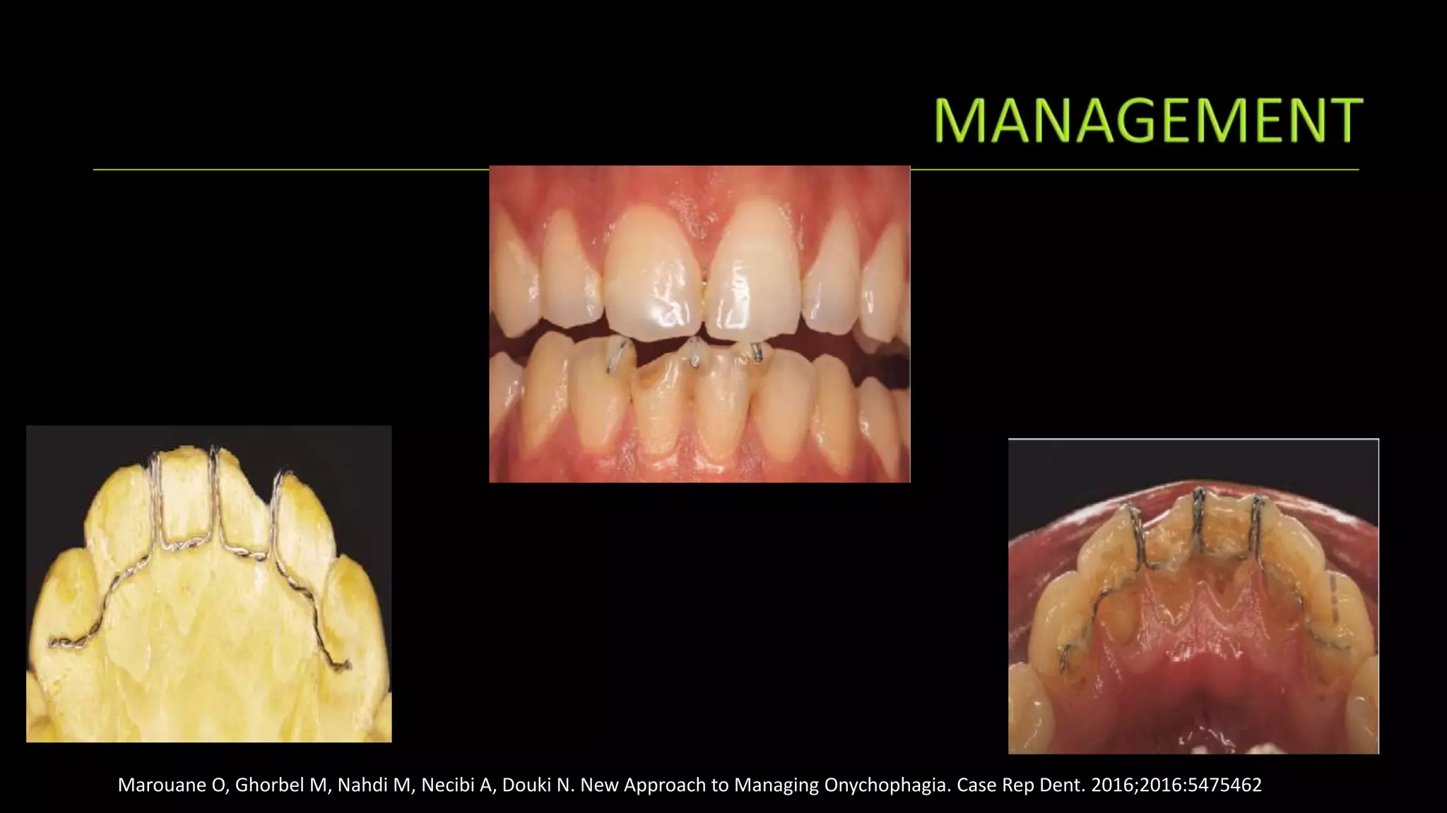 Parafunctional habits in prosthodontics | PPTX