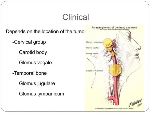 Paraganglioma (2) | PPTX | Ear, Nose and Throat Conditions | Diseases ...
