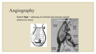 Paraganglioma in head and neck | PPTX