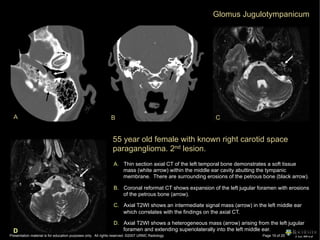 paragangliomas of head and neck FDG PET CT | PDF