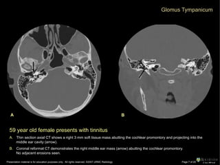 paragangliomas of head and neck FDG PET CT | PDF