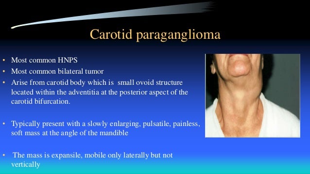 Paragangliomas of head and neck