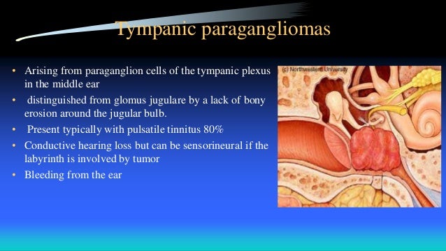 Paragangliomas of head and neck