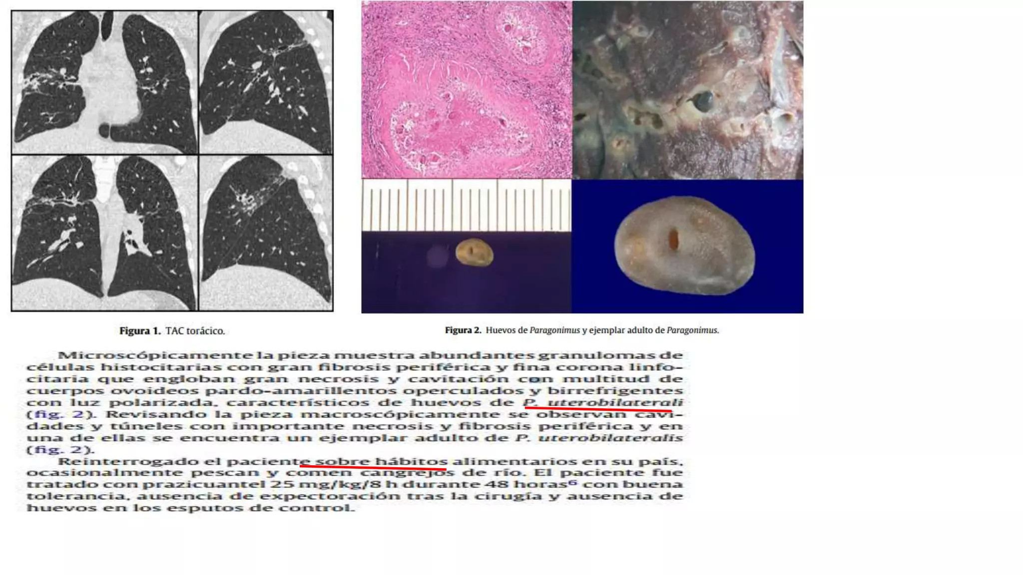 Paragonimiasis Pulmonar - Síndrome de Loeffler | PPTX