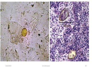 Paragonimus Westermani Lung