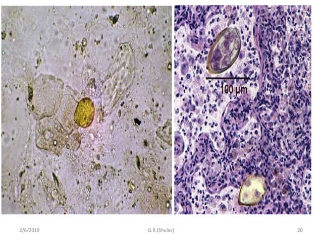 Paragonimus westermani