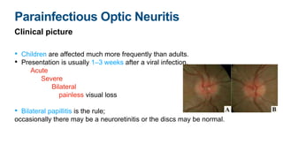 Parainfectious optic neuritis | PPTX