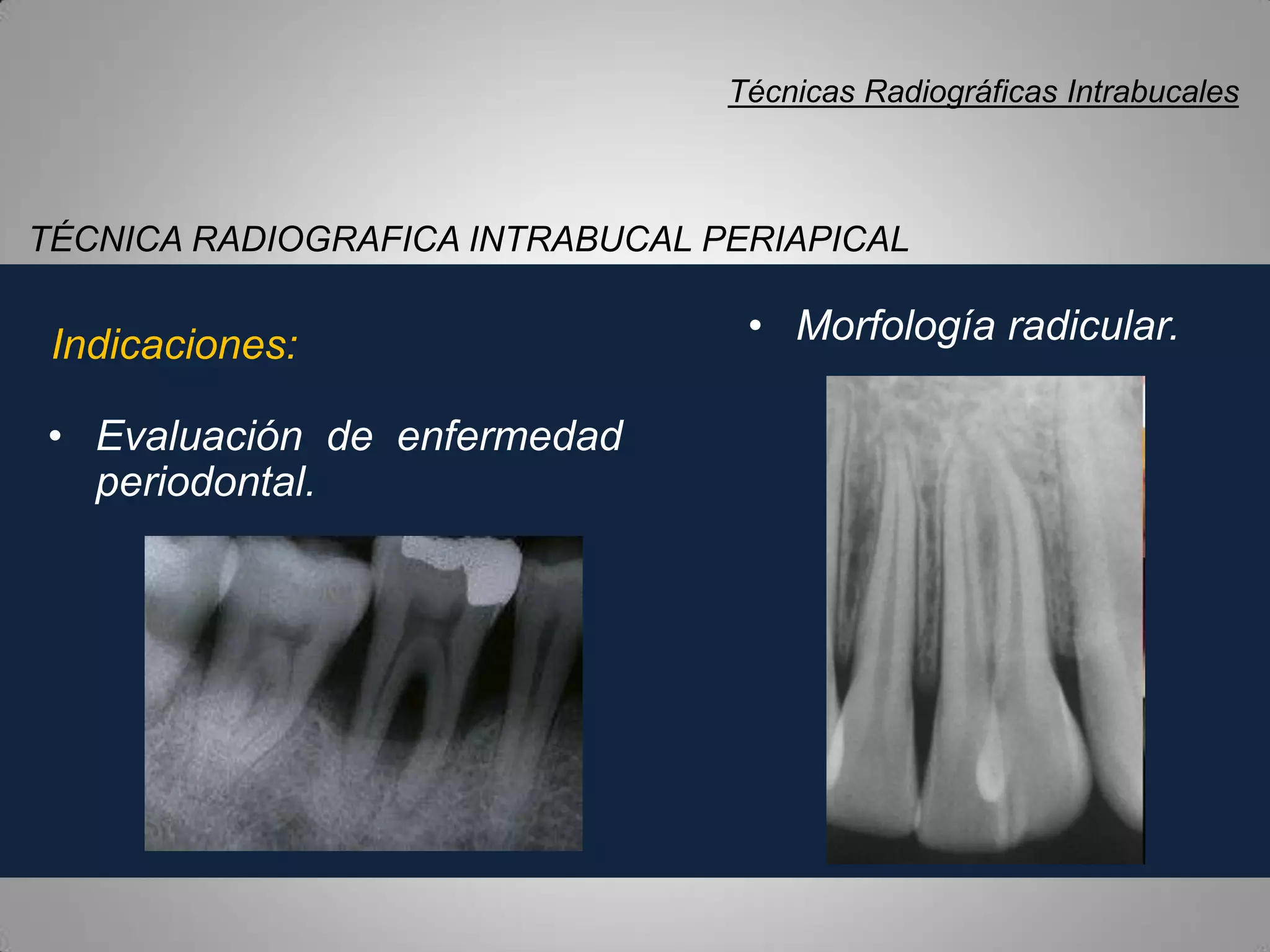 Tecnica radiografica periapical Paralela | PDF