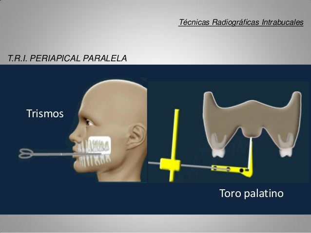 Tecnica radiografica periapical Paralela