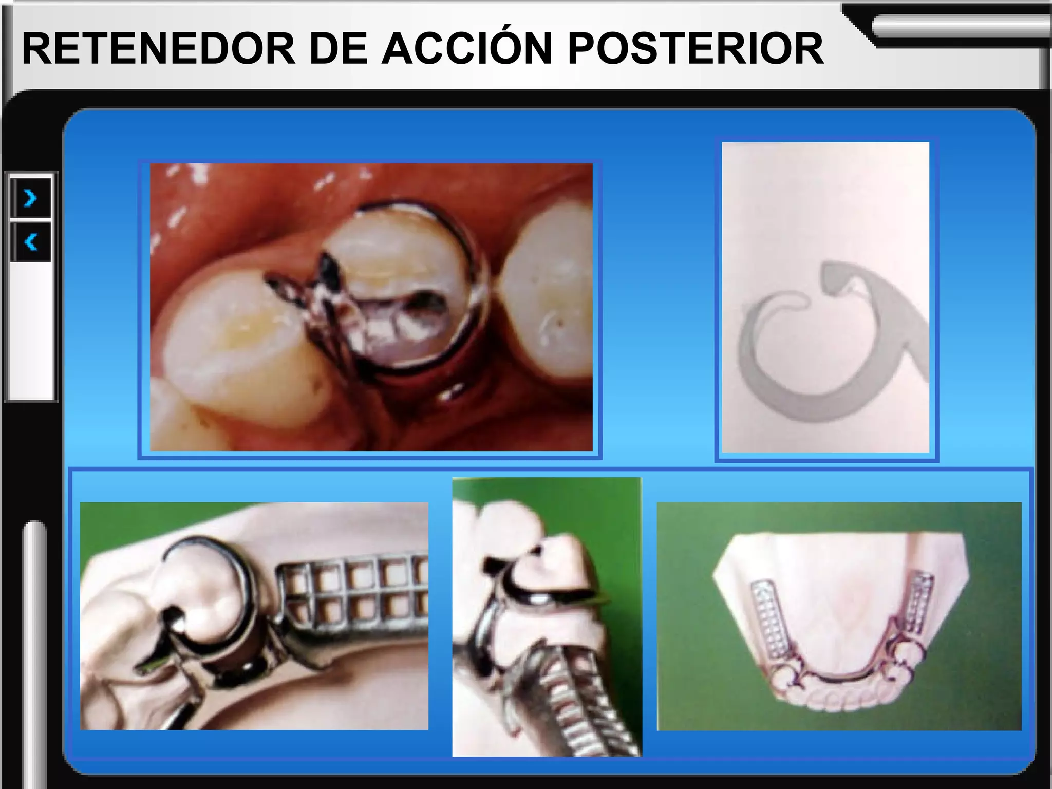 Paralelizacion y biomecanica de prótesis parcial removible | PPT