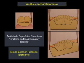 Paralelómetro | PPTX