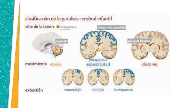 Paralisis cerebral infantil