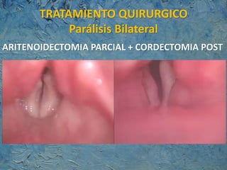 Paralisis laringea | PPT